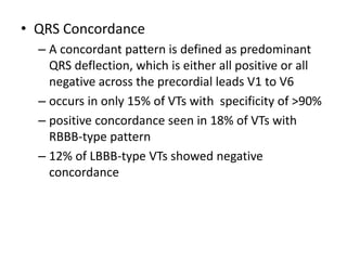 Ventricular tachycardia | PPTX