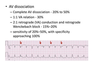 Ventricular tachycardia | PPTX