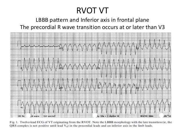 Ventricular tachycardia