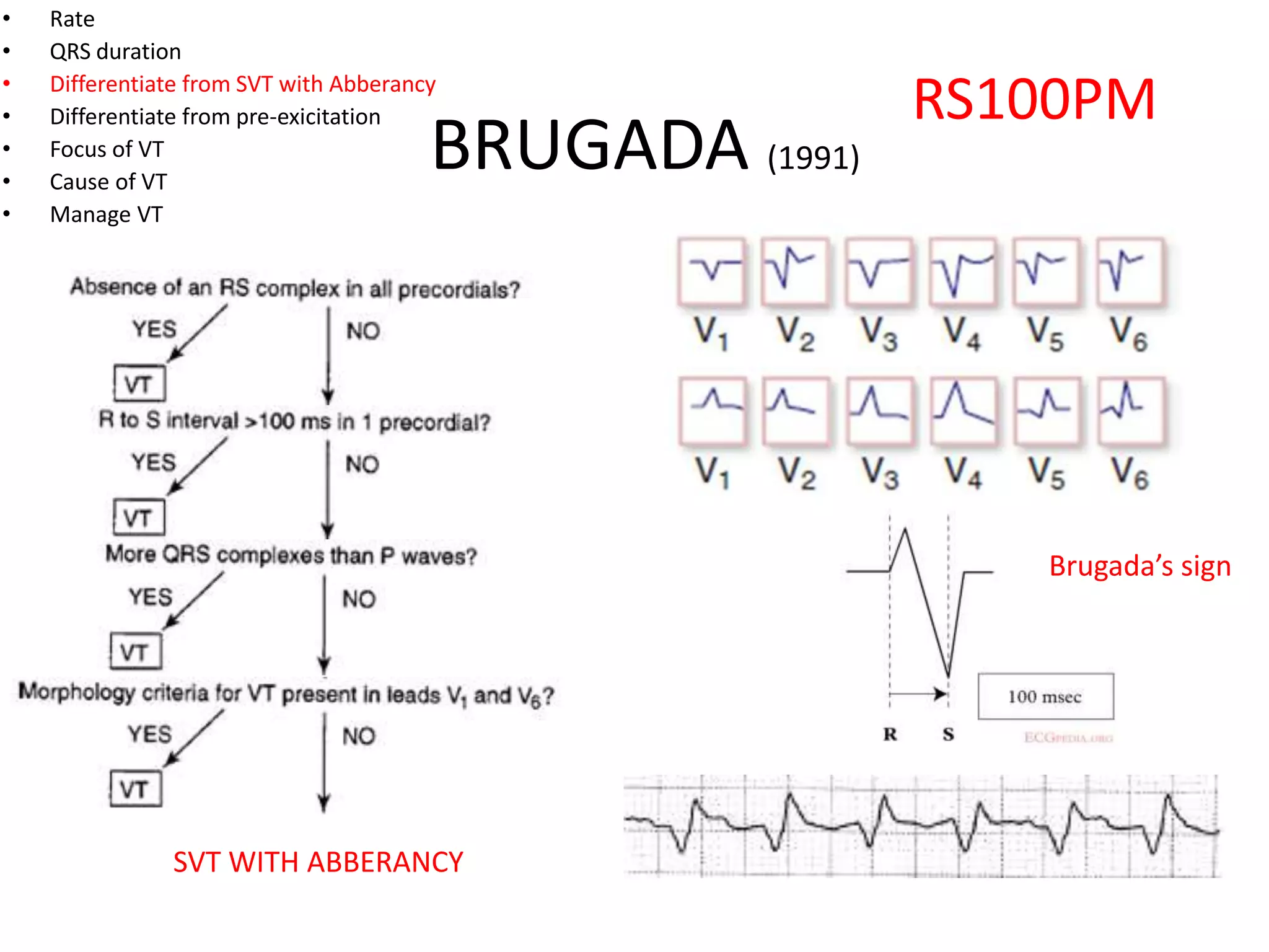 Ventricular tachycardia | PPTX