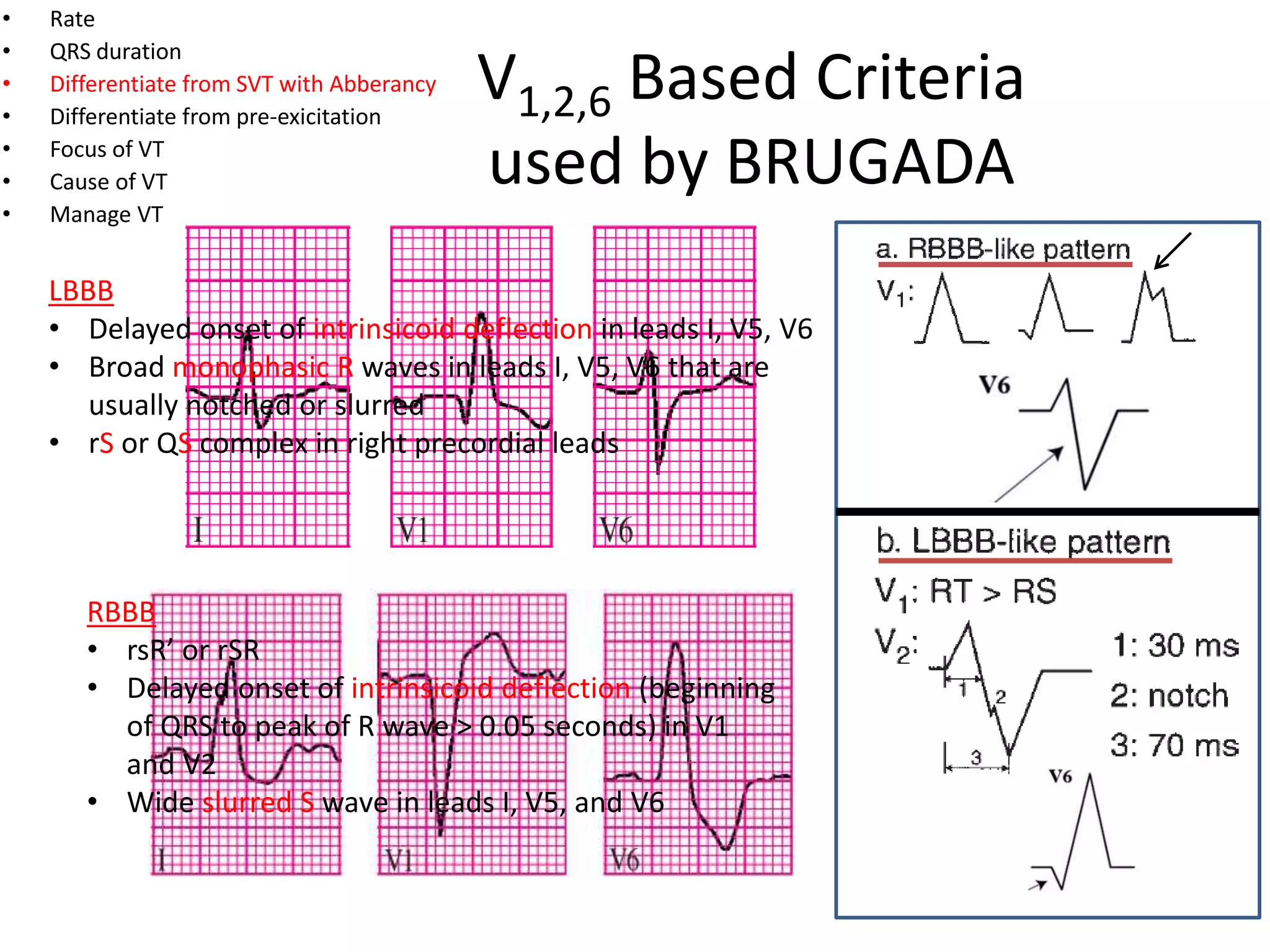 Ventricular tachycardia | PPTX