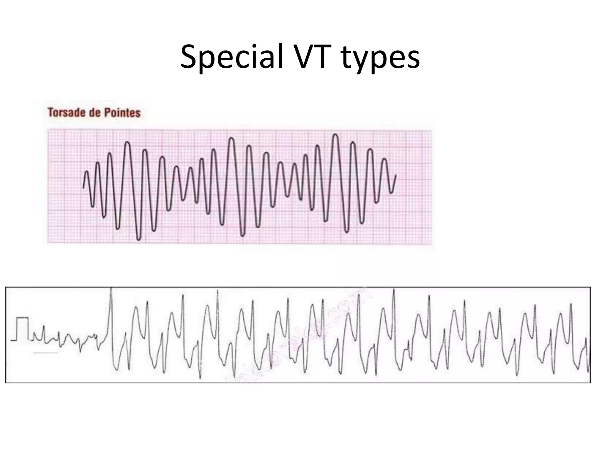 Ventricular tachycardia | PPTX