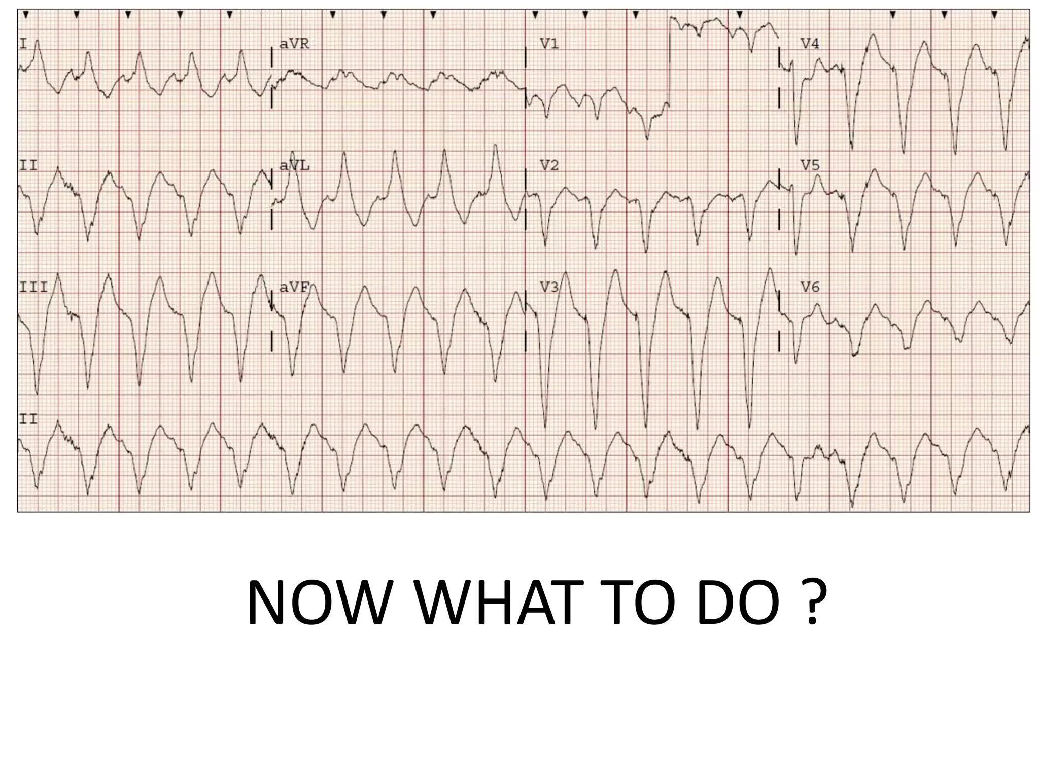 Ventricular tachycardia | PPT