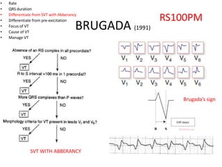 Ventricular tachycardia | PPTX