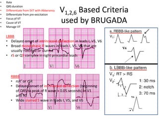 Ventricular tachycardia | PPTX