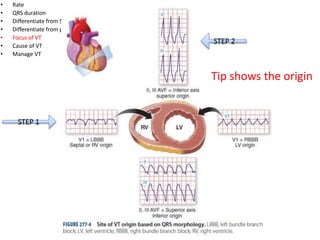 Ventricular tachycardia | PPTX