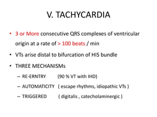 Ventricular tachycardia | PPTX