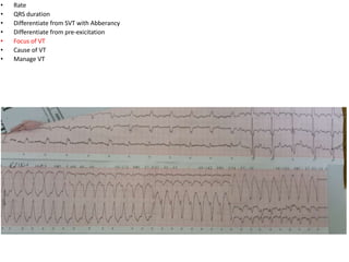Ventricular tachycardia | PPTX