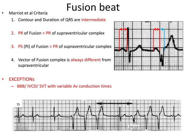 Ventricular tachycardia | PPT