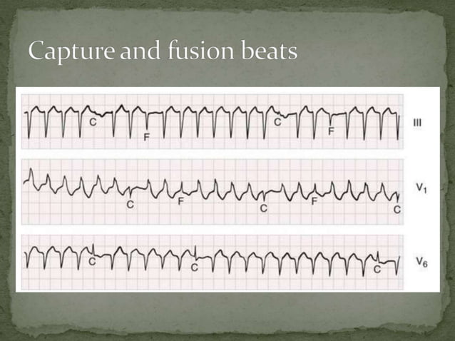 Ventricular tachycardia | PPT