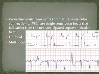 Ventricular tachycardia | PPT
