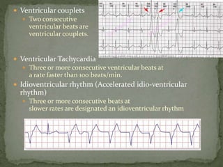 Ventricular tachycardia | PPT