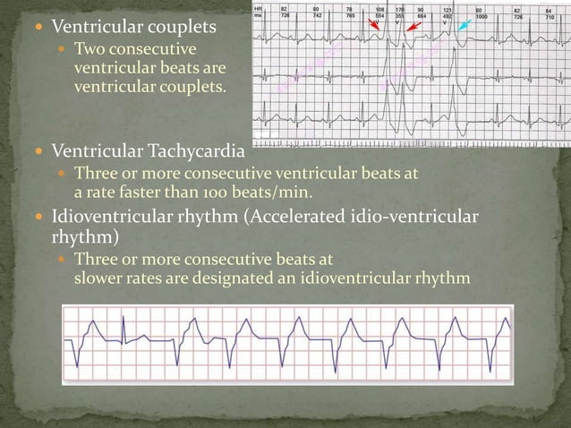 Ventricular tachycardia | PPT