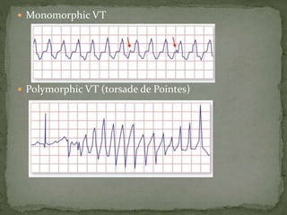 Ventricular tachycardia | PPT