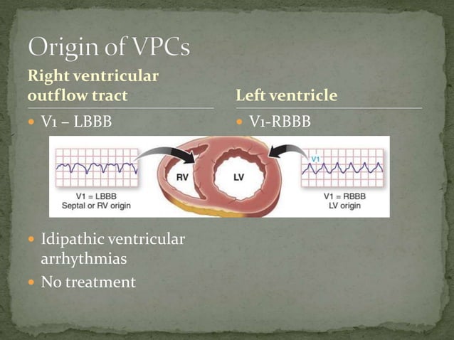 Ventricular tachycardia | PPT