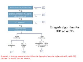 Ventricular tachycardia- ECG based approach | PPTX