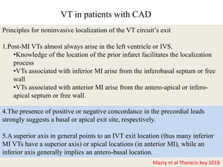 Ventricular tachycardia- ECG based approach | PPTX