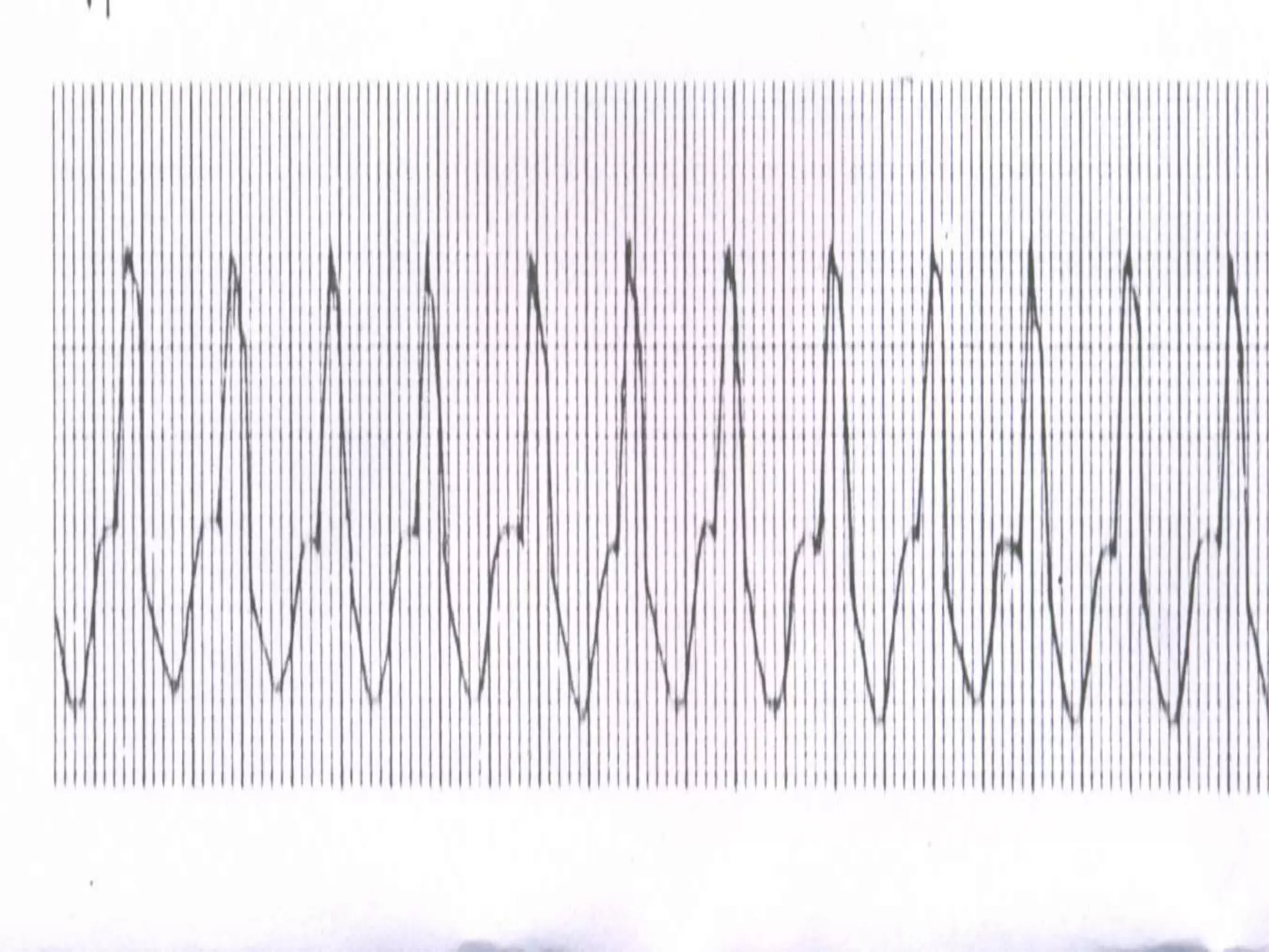 Ventricular tachycardia | PPT