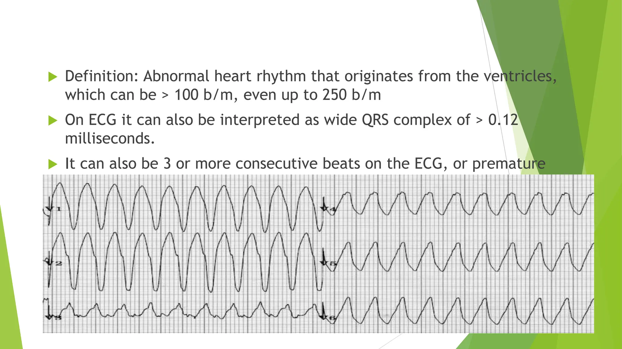 VENTRICULAR TACHYCARDIA..............pptx