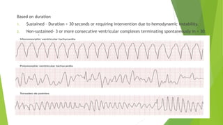 VENTRICULAR TACHYCARDIA..............pptx