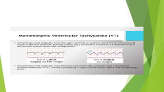 VENTRICULAR TACHYCARDIA..............pptx
