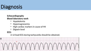 Ventricular tachycardia Essential topic.pptx