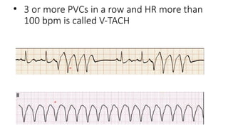 Ventricular tachycardia Essential topic.pptx