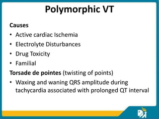 Ventricular tachycardia | PPTX