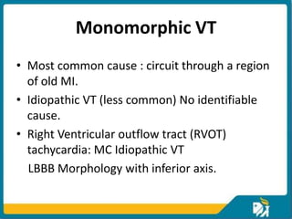 Monomorphic Ventricular Tachycardia