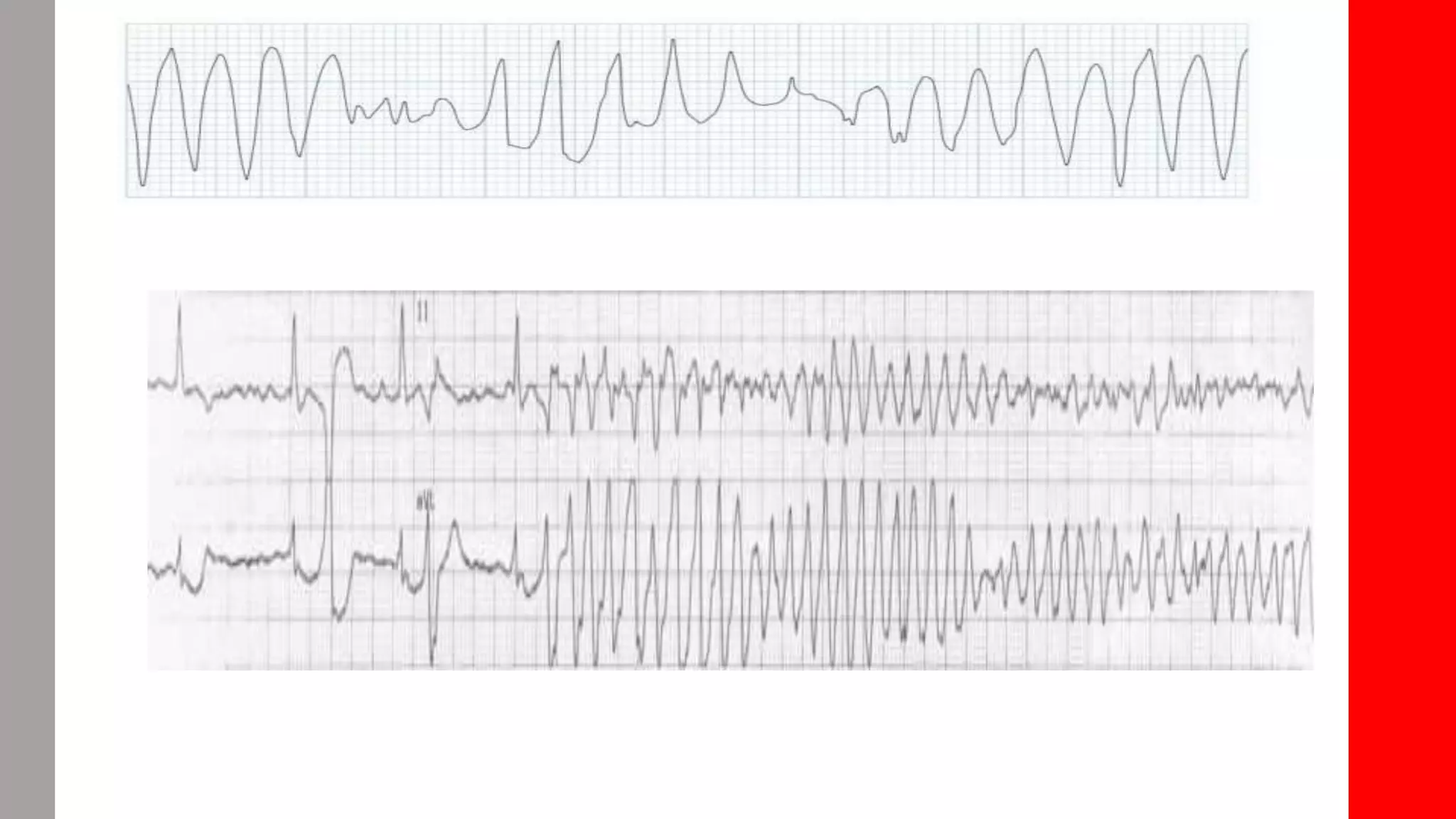 Ventricular tachycardia, ventricular flutter, and ventricular ...