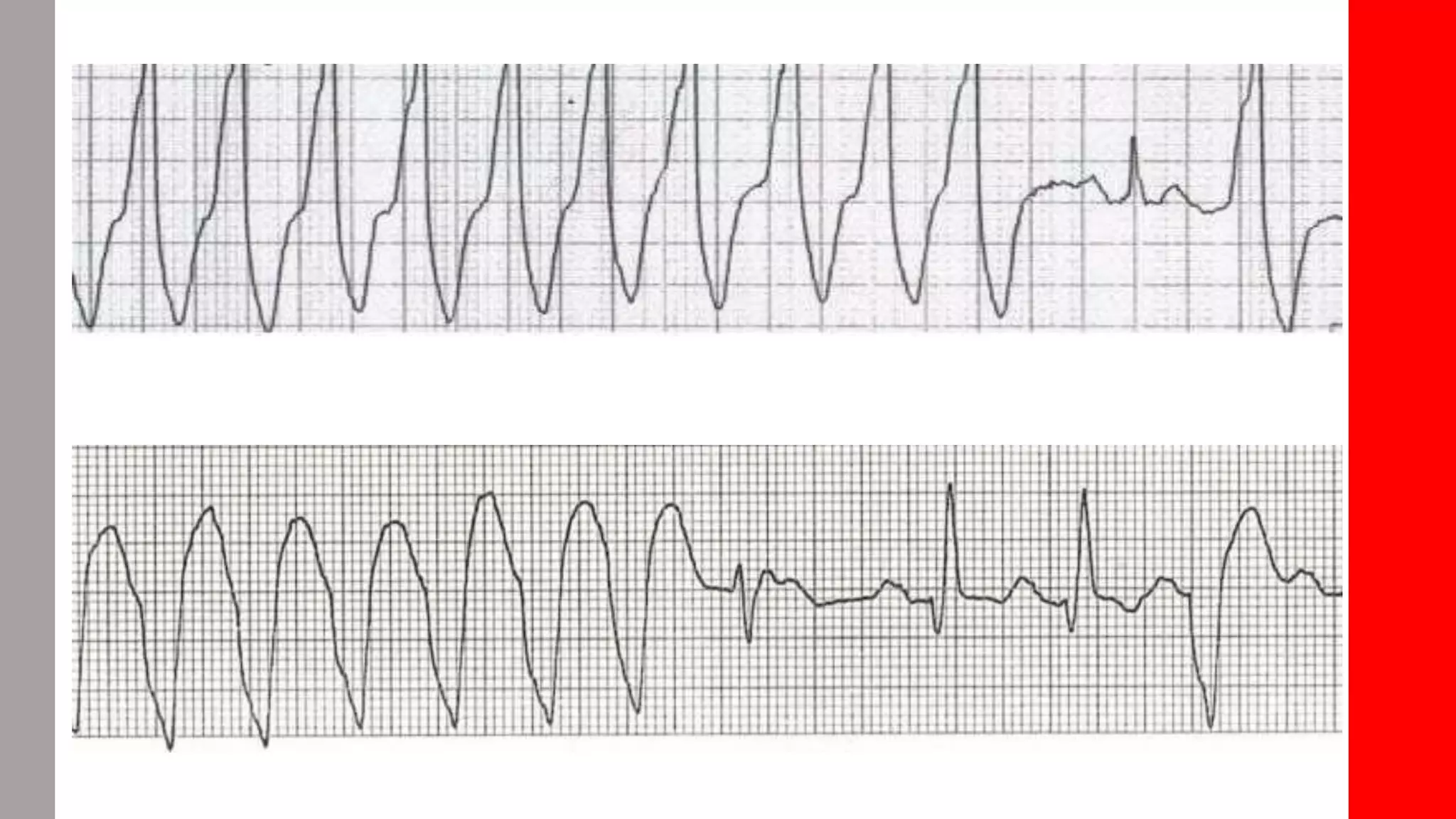 Ventricular tachycardia, ventricular flutter, and ventricular ...