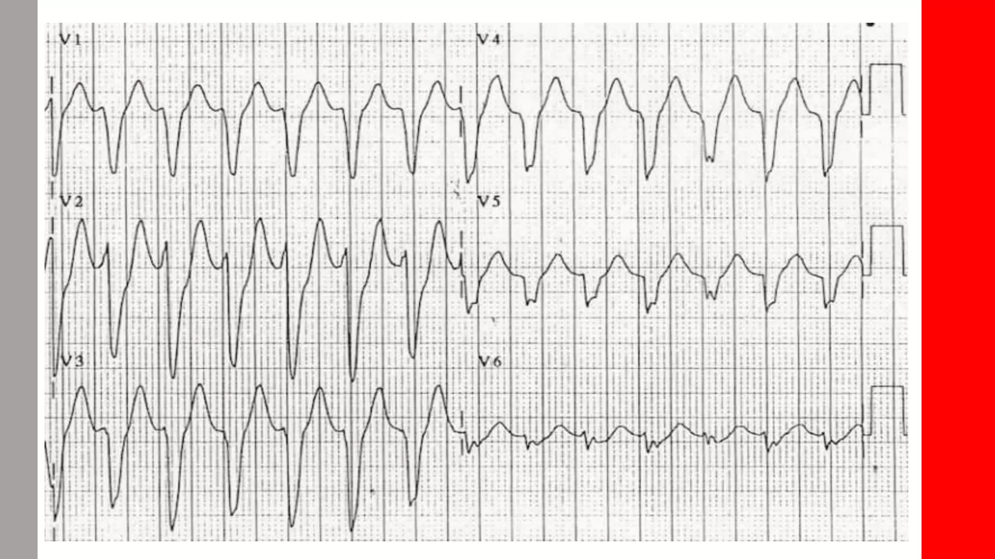 Ventricular tachycardia, ventricular flutter, and ventricular ...