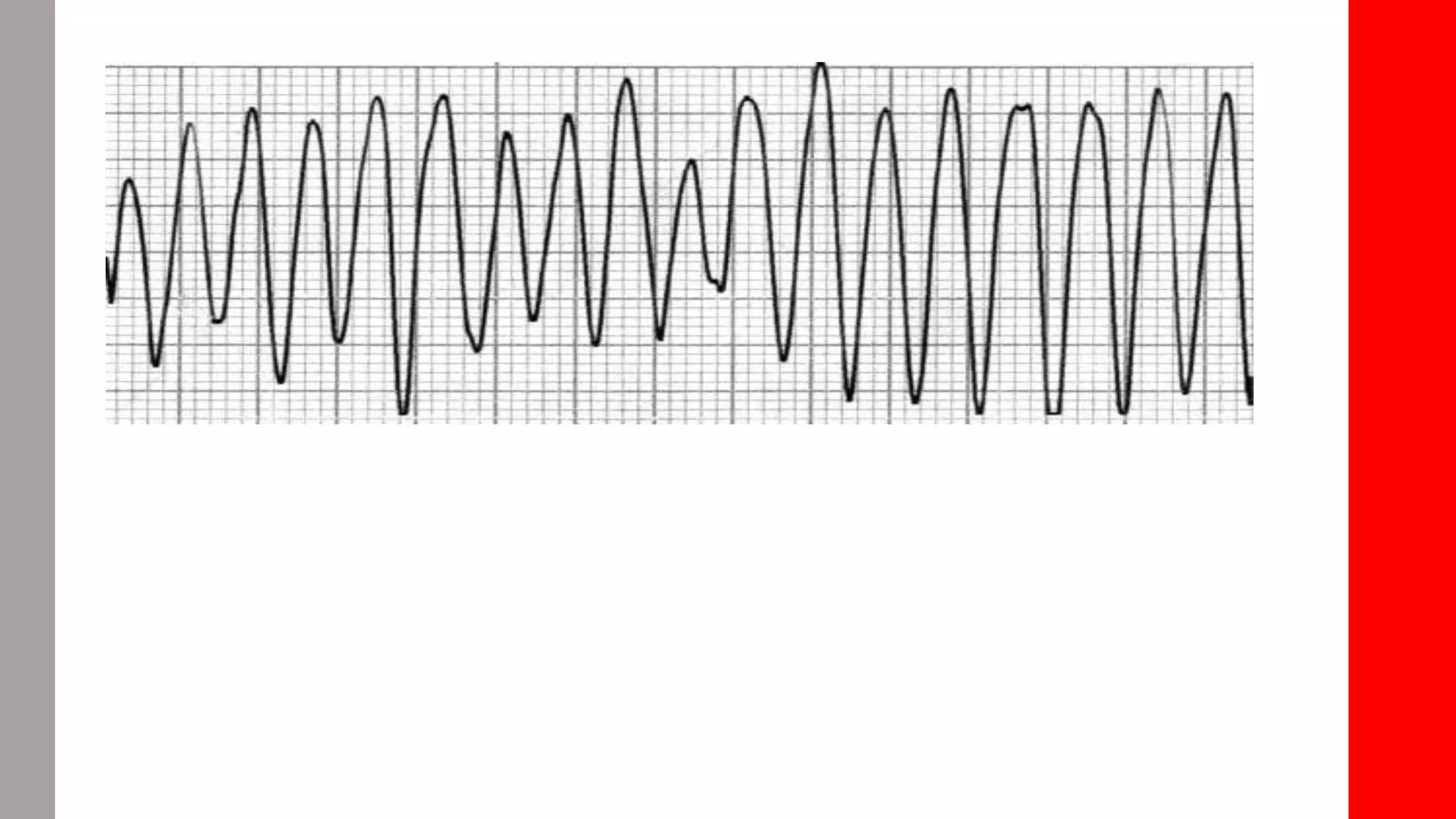 Ventricular Flutter Vs Fibrillation Sudden Cardiac Arrest (SCA) Vs