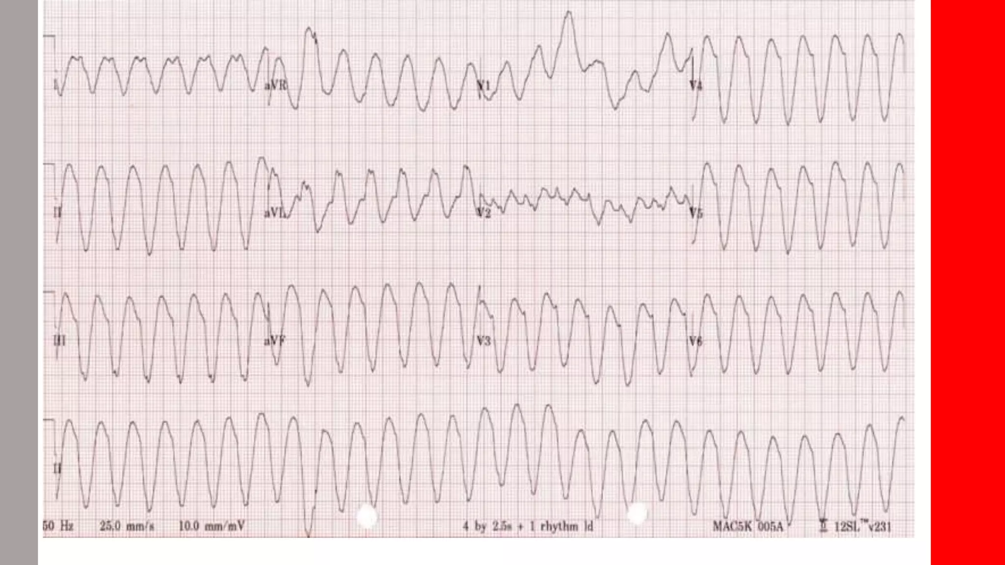 Ventricular tachycardia, ventricular flutter, and ventricular ...