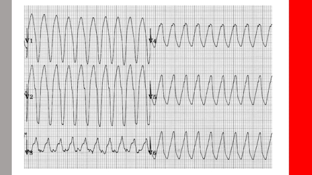 Ventricular tachycardia, ventricular flutter, and ventricular ...