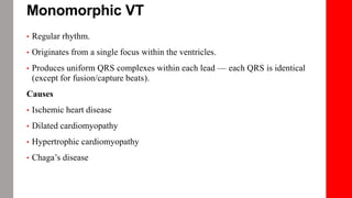 Ventricular tachycardia, ventricular flutter, and ventricular ...