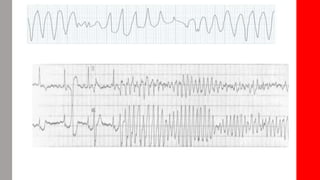 Ventricular Flutter Vs Fibrillation