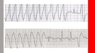 Ventricular Flutter Vs Torsades
