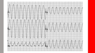 Ventricular Flutter