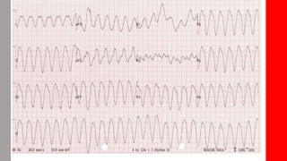 Ventricular Flutter Vs Torsades