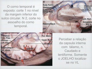 Ventriculos laterais e iii ventriculo | PPTX