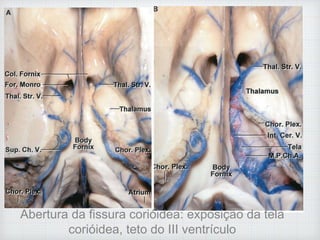 Ventriculos laterais e iii ventriculo | PPTX