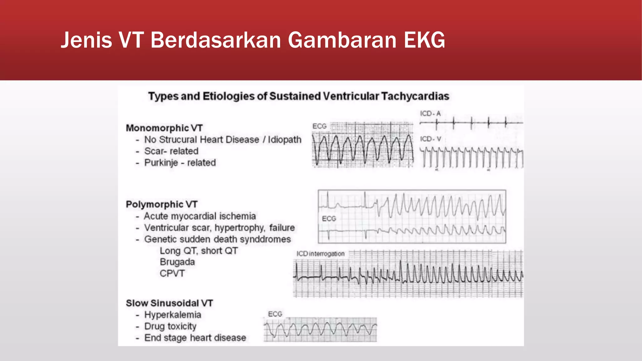 Ventrikel Takikardia.pptx