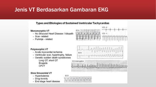 Ventrikel Takikardia.pptx