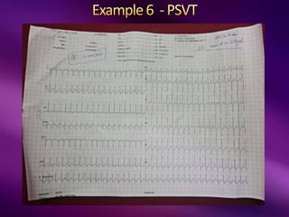 Vent tachy 26 Oct 2022.pptx