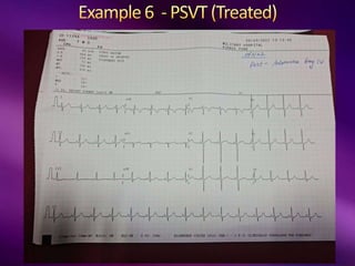Vent tachy 26 Oct 2022.pptx