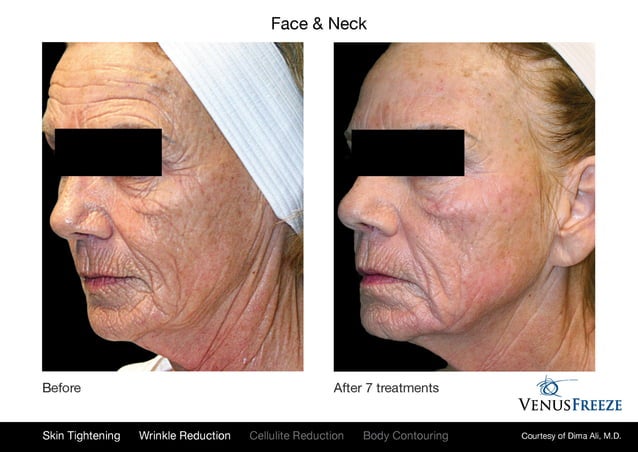 Venus Freeze Before and After Photos | PDF