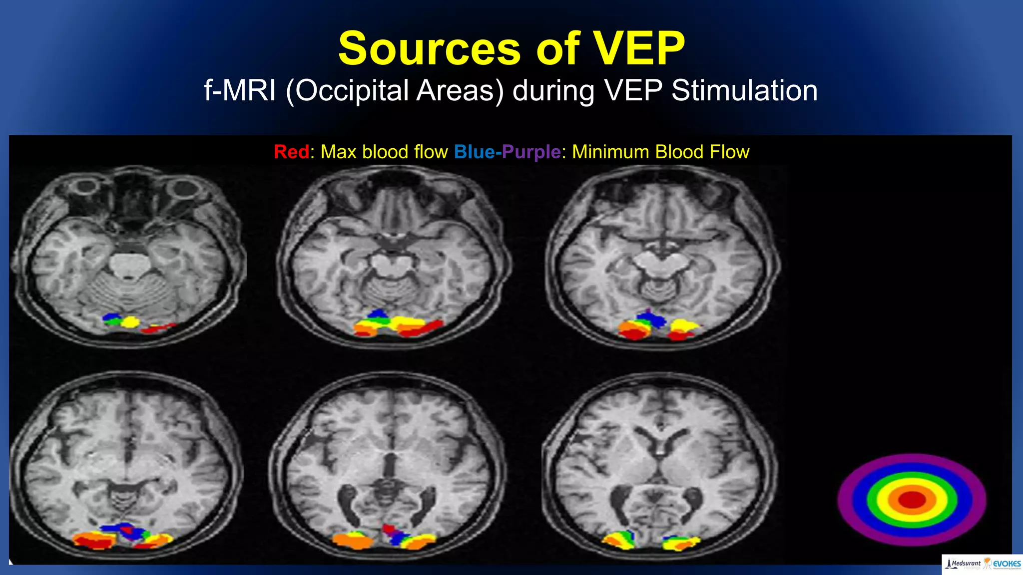 Intraoperative Flash Visual Evoked Potentials | PPT