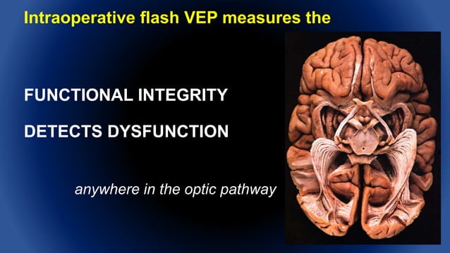 Intraoperative Flash Visual Evoked Potentials | PPT