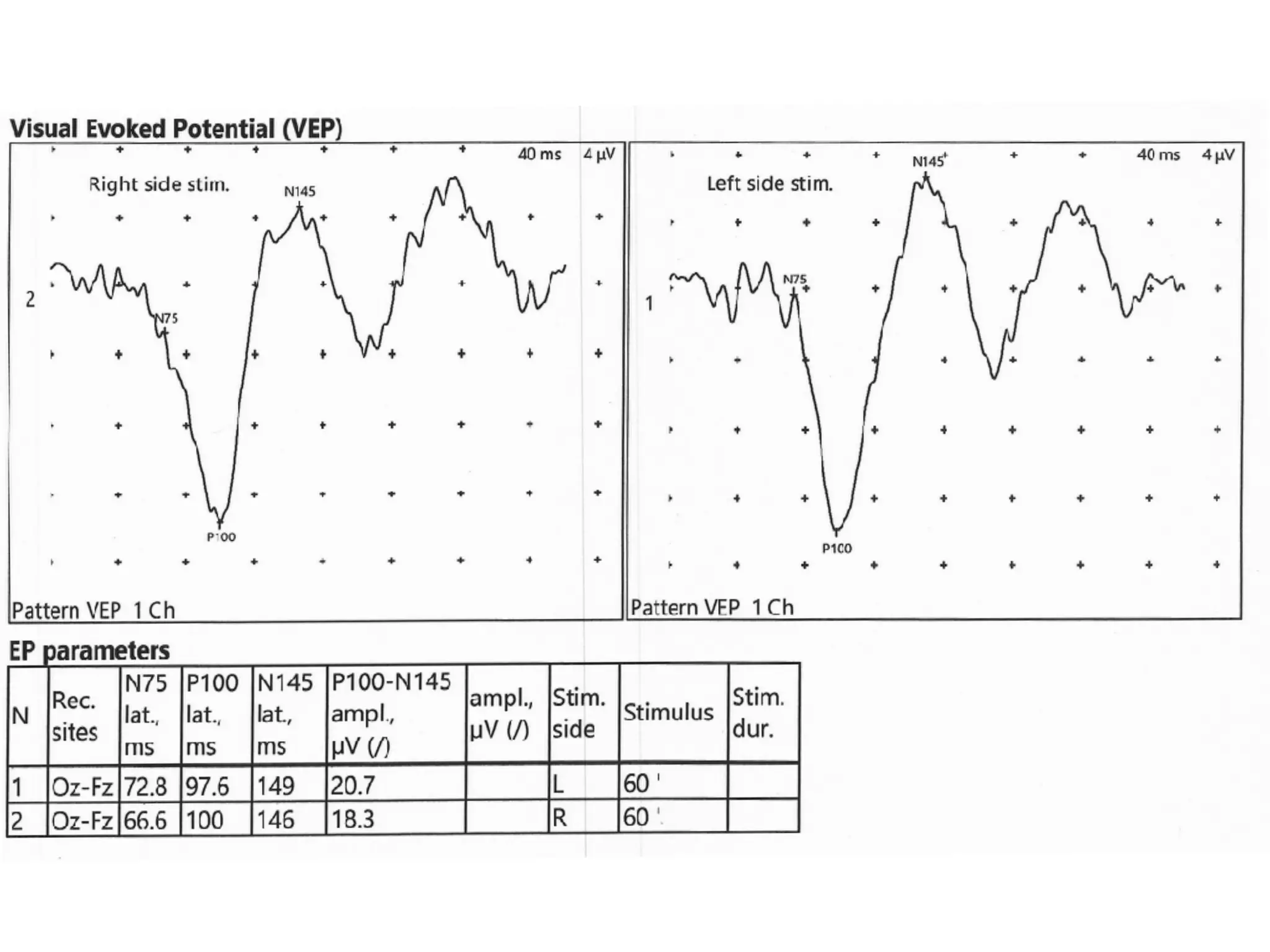 Visual Evoked Potentials | PDF